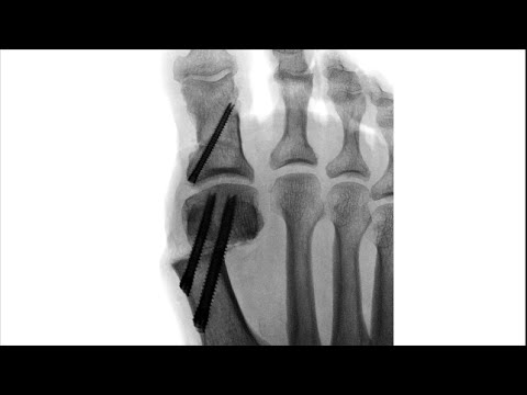 Arthrex Minimally Invasive Bunionectomy Surgical Technique - YouTube