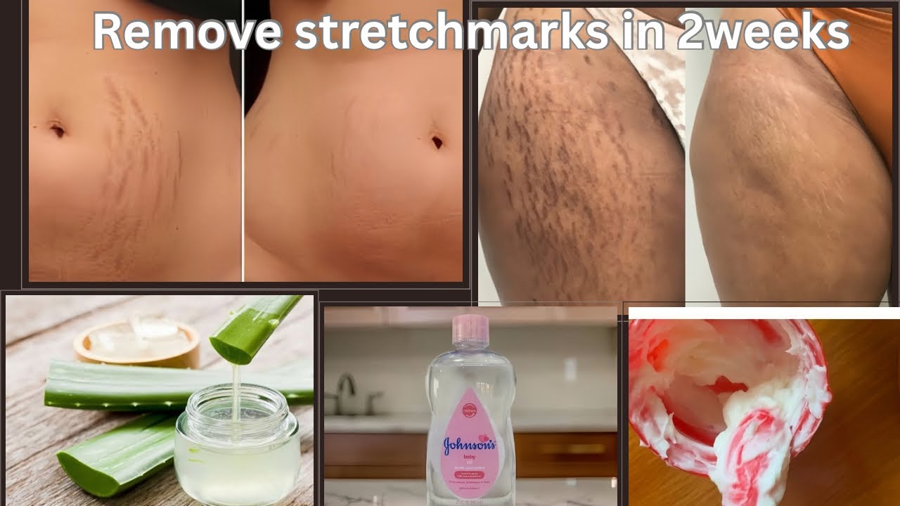 Stretch marks removal how to get rid of-stretch marks in two weeks easy ...