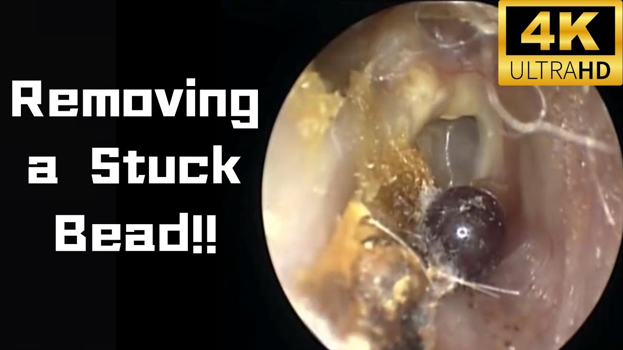 ASMR Ear Cleaning: Removing a Stuck Bead!|ear wax removal | ear ...
