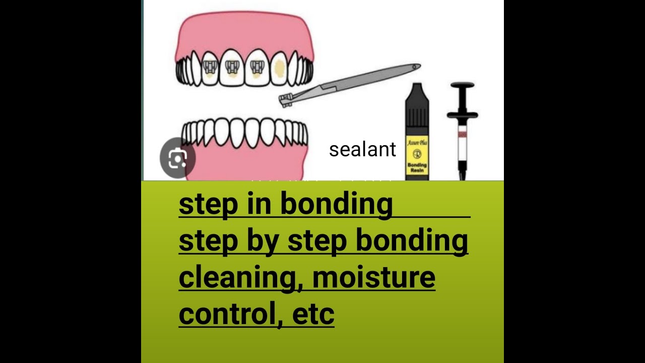 BONDING || STEP BY STEP || BONDING OF BRACKETS || ORTHODONTICS - YouTube