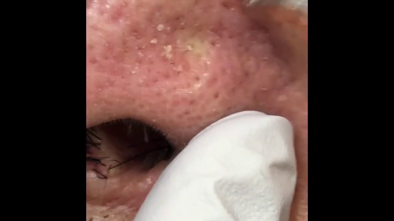 Remove pimples - great pressure to a great extent - YouTube
