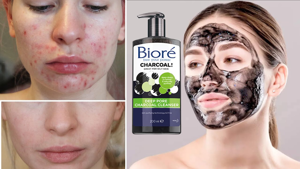 Biore Charcoal Cleanser Review | Acne Clearing Facial Cleanser with 1% ...