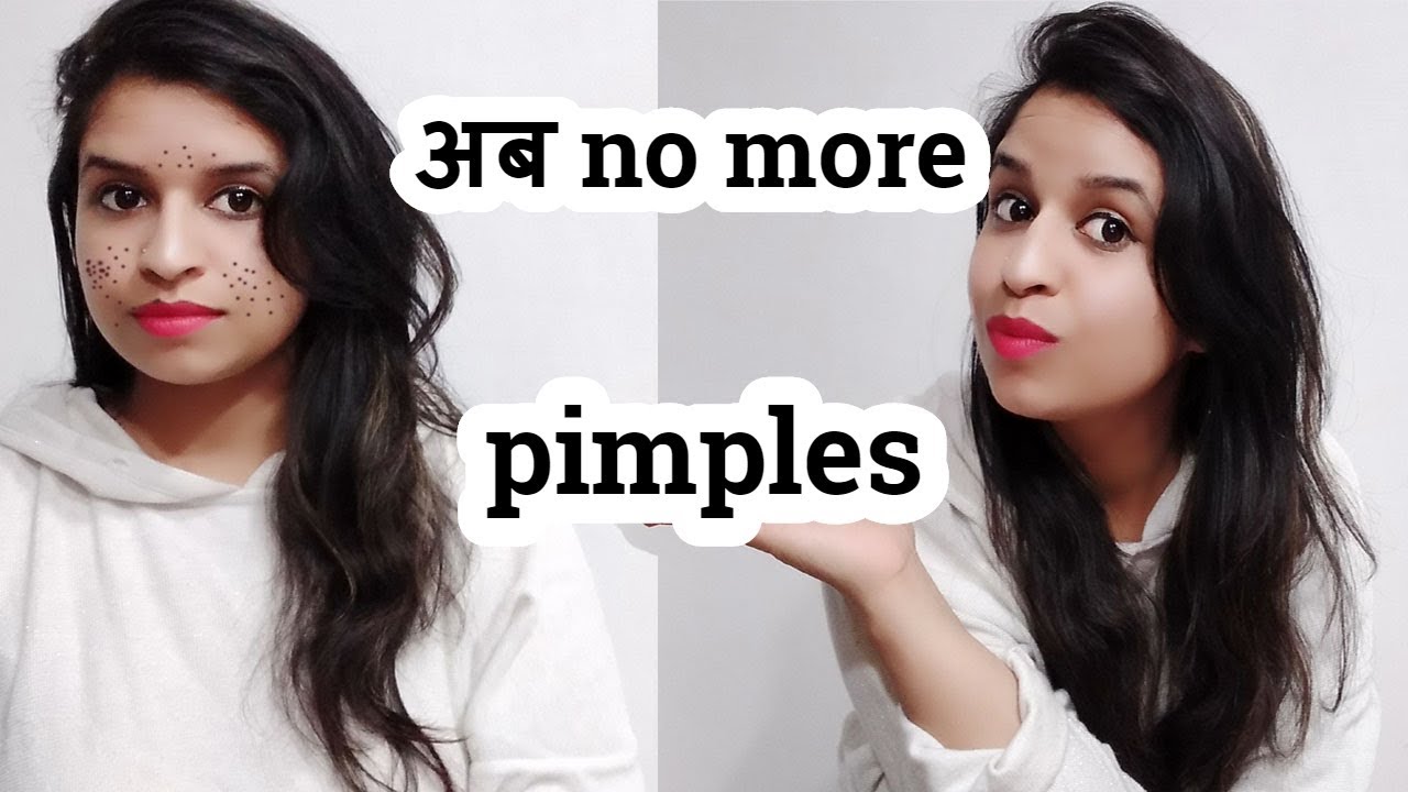 How To Remove Pimple & ACNE !! remove pimples naturally - YouTube
