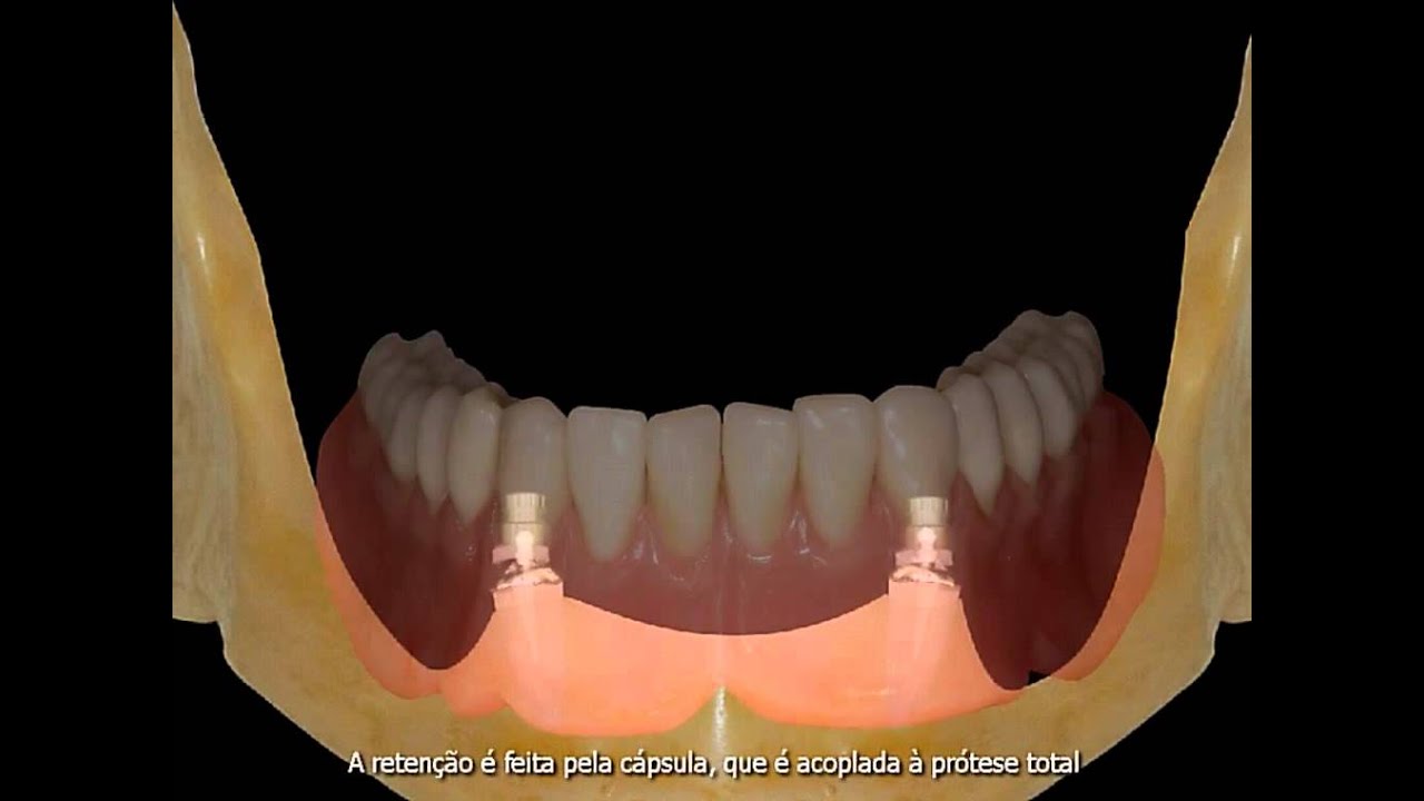 PT Overdenture Sobre Dentes - YouTube