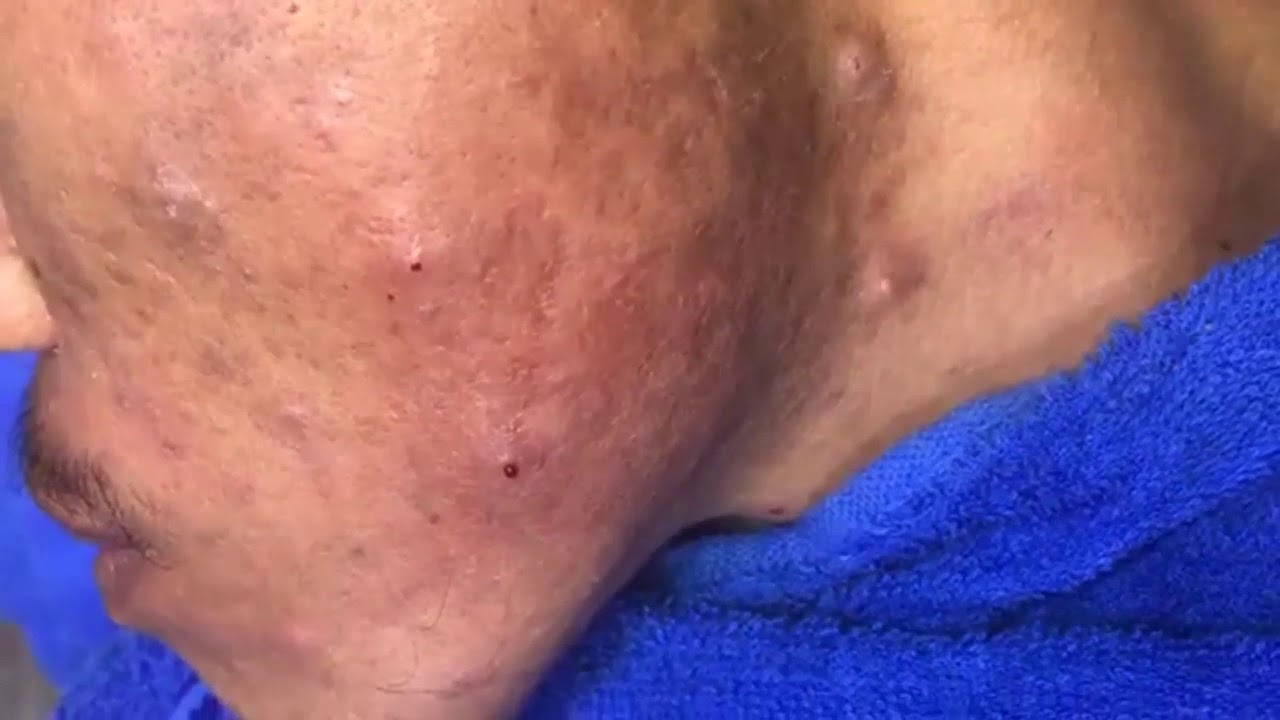 Most Satisfying Video For Facial Skin Care #60, การดูแลรักษาผิวหน้า ...