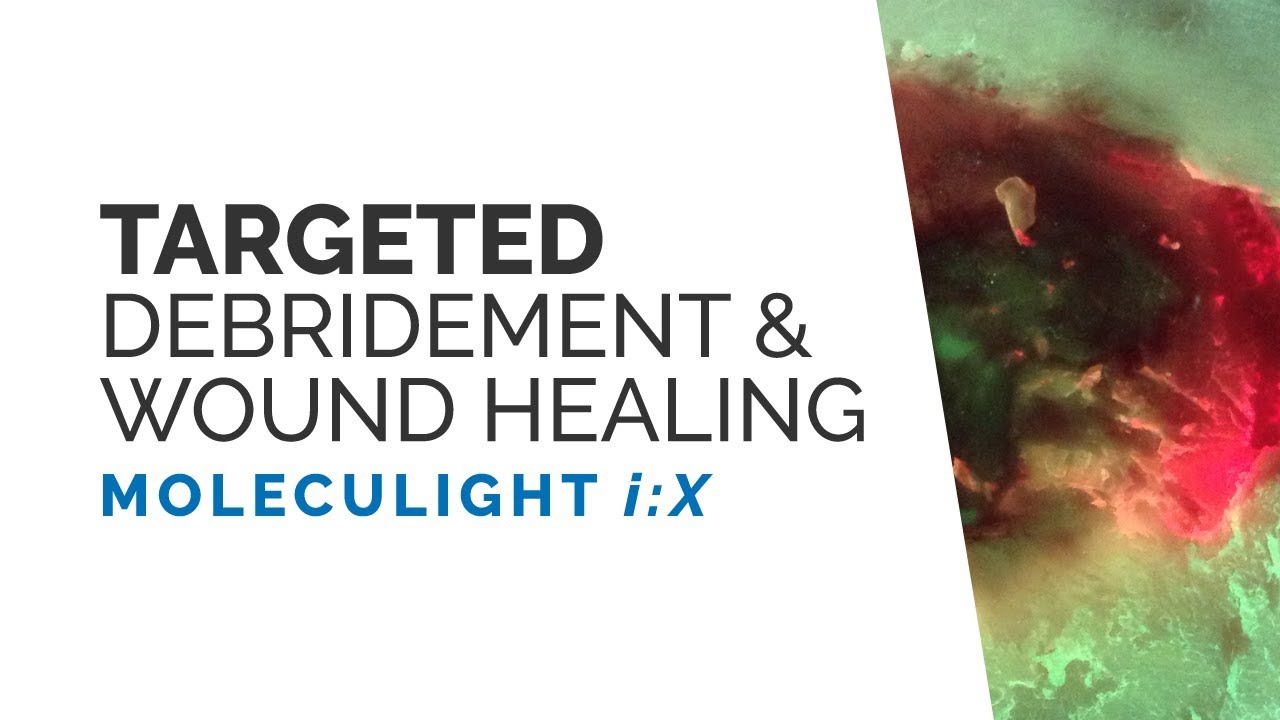 MolecuLight Wound Mapping Guide to Targeted Debridement and Wound ...