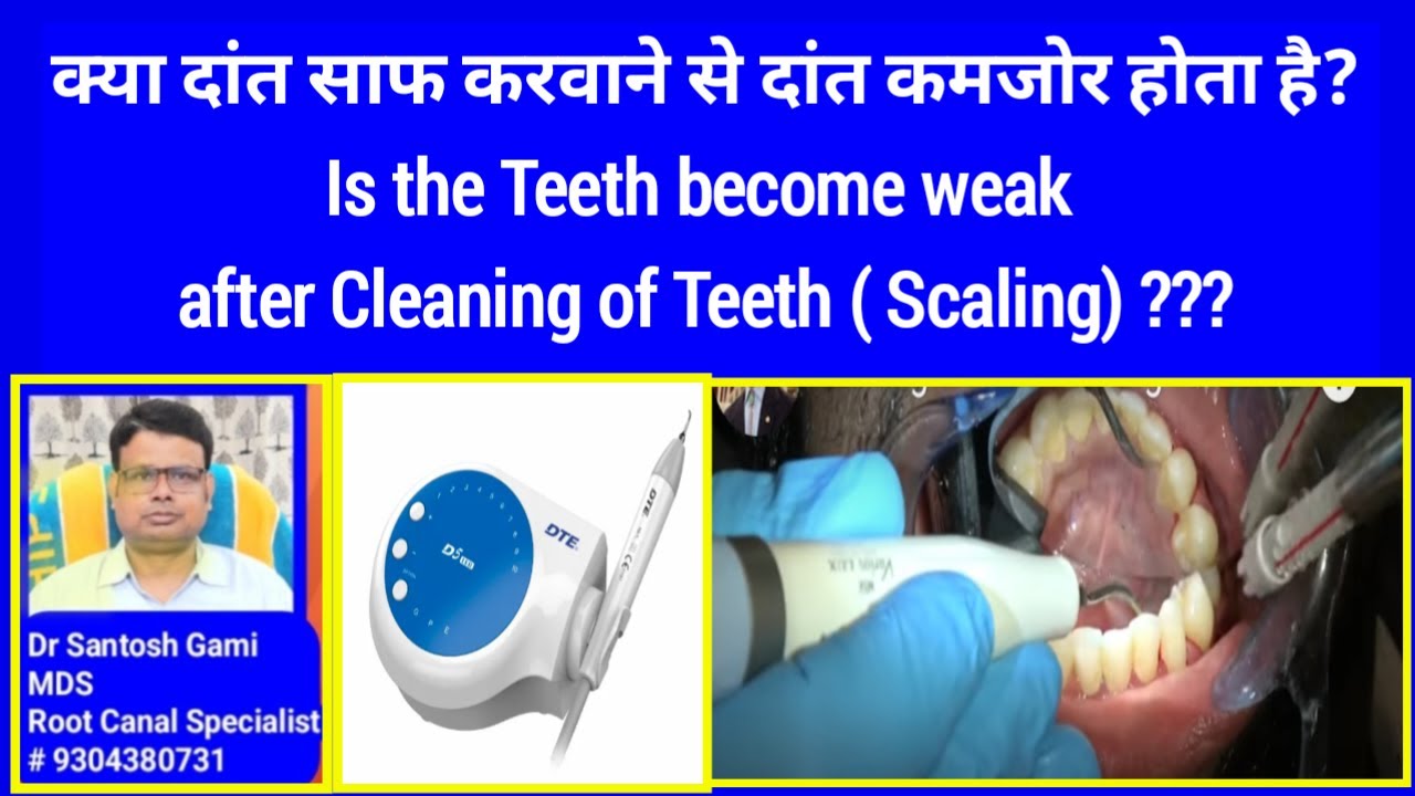 क्या दांत साफ करवाने से दांत कमजोर होता है ? Is the Teeth become weak ...