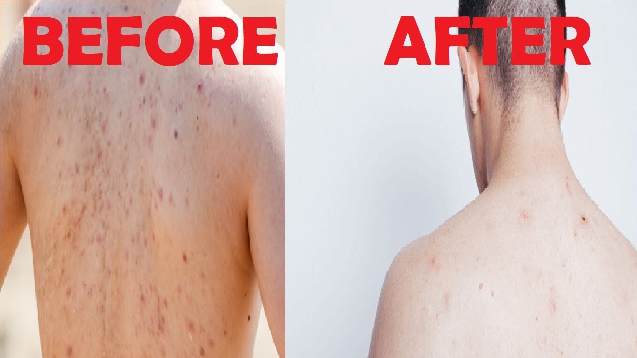 how to get rid of back acne in only 3 days - YouTube