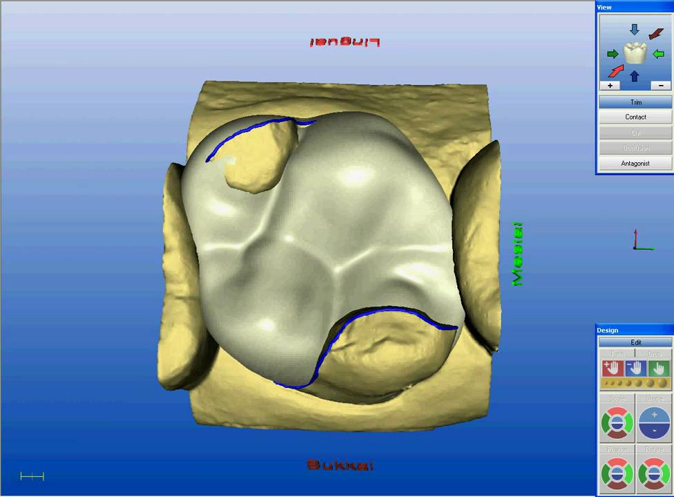 Making of an onlay (CEREC) - YouTube