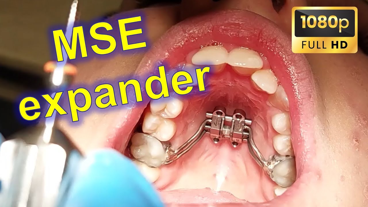 😲 MSE - Maxillary Skeletal Expander MARPE - YouTube