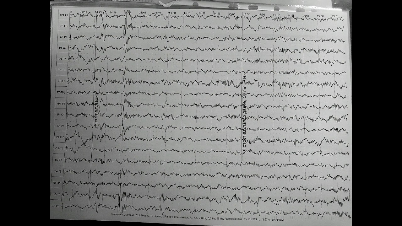 Paroxysmal epileptiform activity in eeg of a child with medication ...