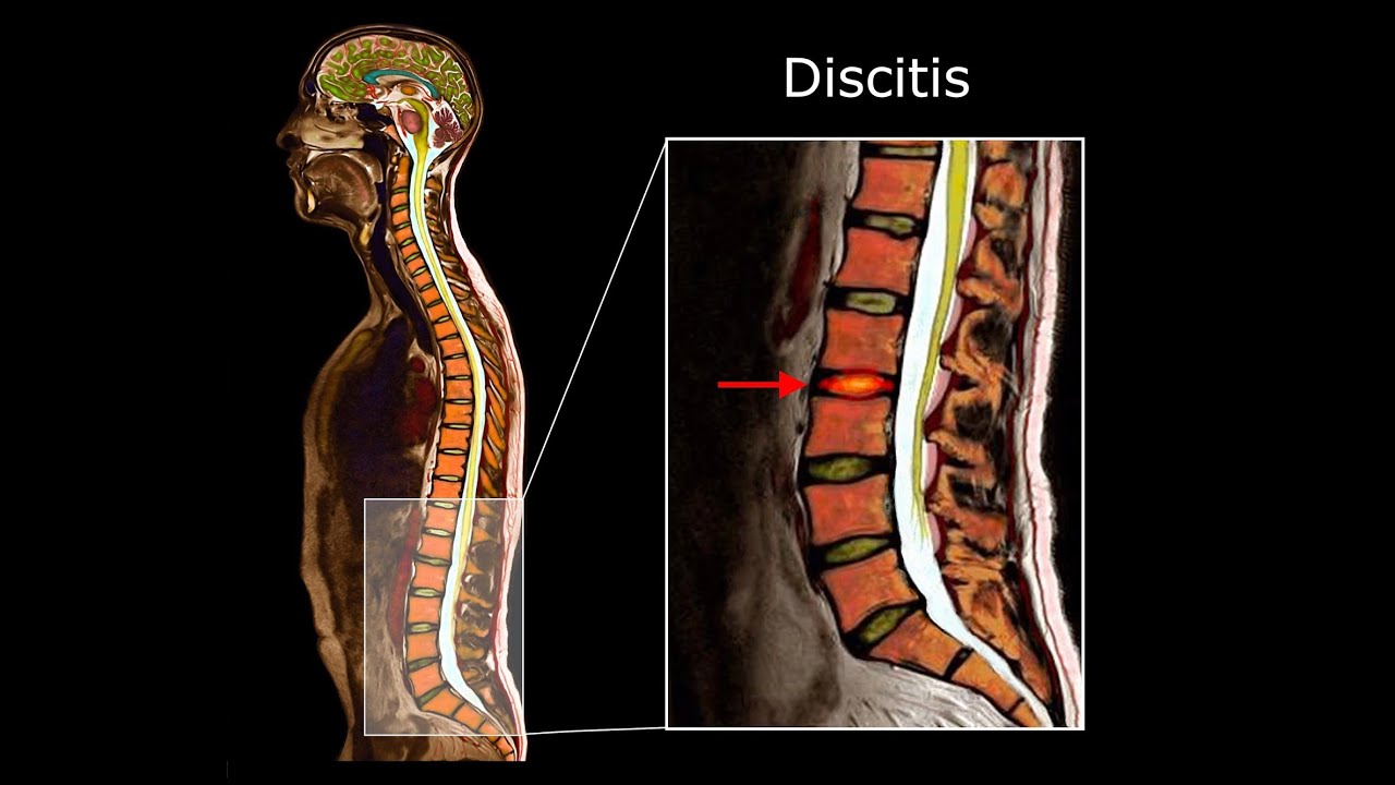 Discitis - YouTube