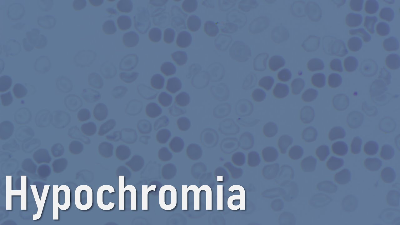 Red cells: Hypochromia - YouTube