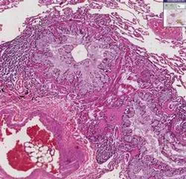 Histopathology Lung--Asthma - YouTube