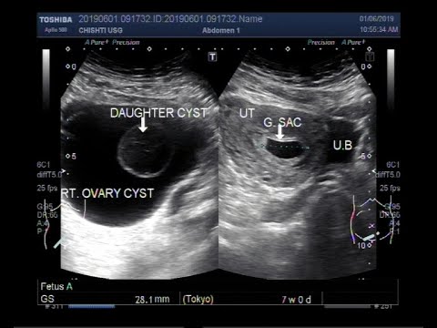 Ultrasound Video showing early anembryonic pregnancy, Ovarian Cyst with ...