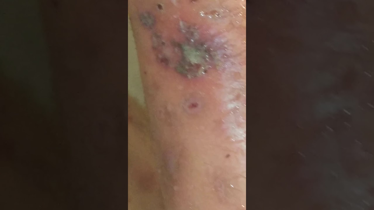 Meth Sores VS Epson Salt - YouTube