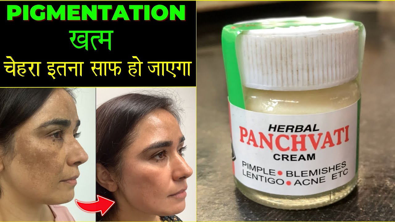 Panchvati cream | Uses, benefits, side effect | clean Pigmintation ...