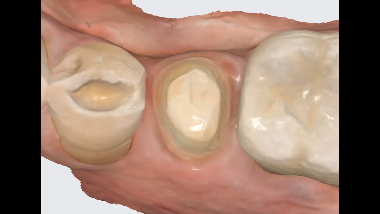 #35 Full Zirconia Preparation - YouTube