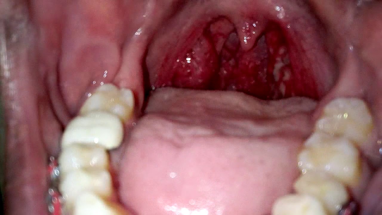 tonsillitis, Video de amigdalitis aguda - YouTube