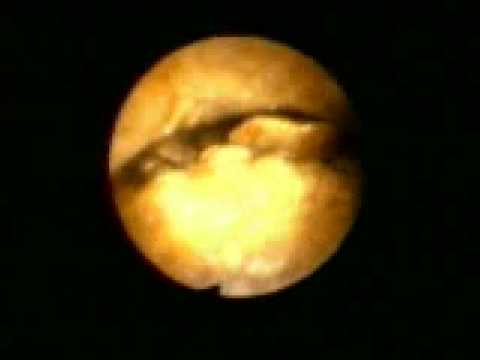 Normal endoscopic appearance of Larynx anatomy - YouTube