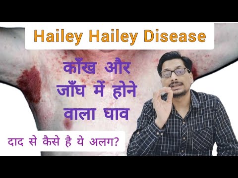 काँख और जाँघ में होने वाला घाव | Hailey Hailey Disease | दाद से कैसे है ...