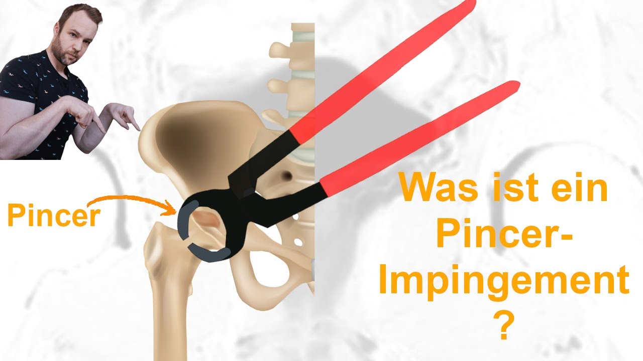 Was ist ein Pincer-Impingement? - YouTube