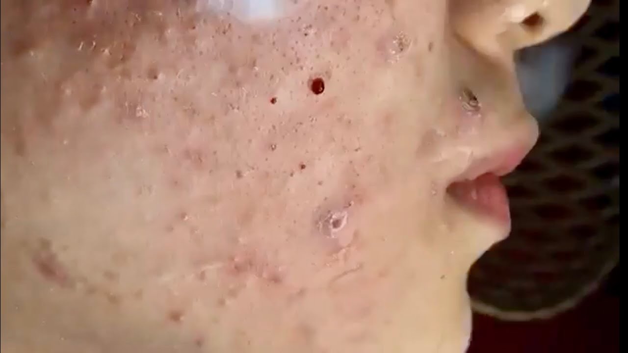 Pimple Popping 2020 Video #34| Blackhead removal, Whitehead removal ...