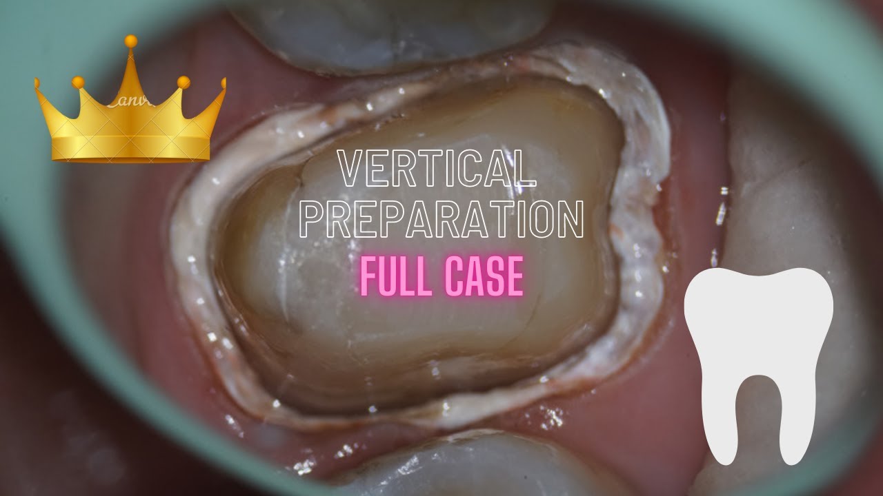 VERTICAL PREPARATION Full case Zirconia Crown - YouTube