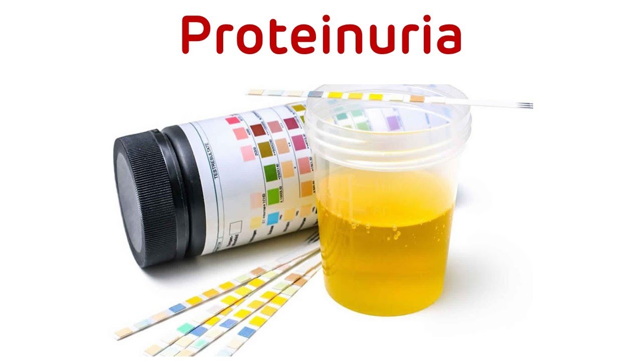 Proteinuria (Protein In Urine) || Proteinuria - Definition, Types And ...
