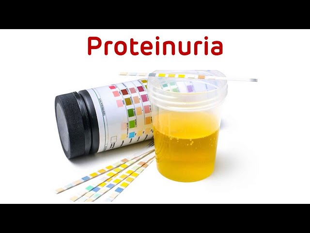 Protein Loss In Urine (Proteinuria) Symptoms, Causes And, 56% OFF