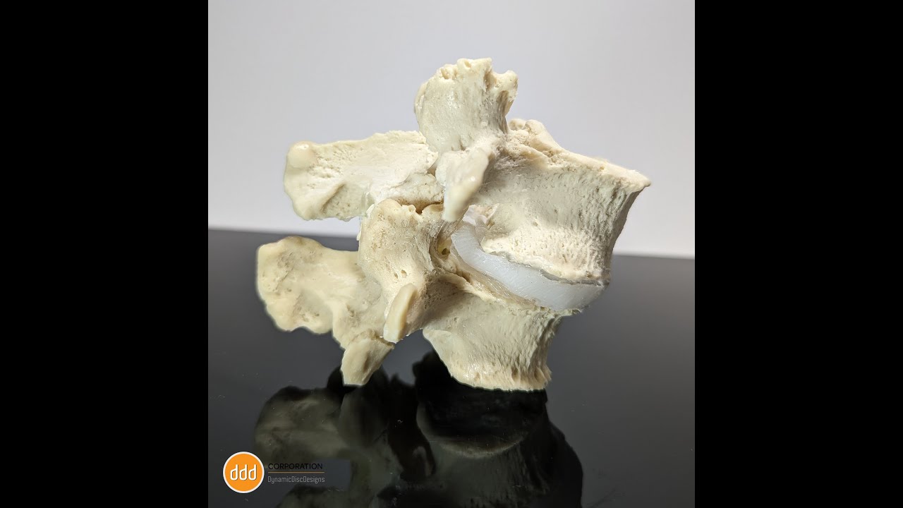 How do we fit the cauda equina up into the degenerative ...