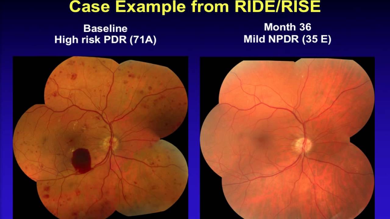Michael Ip, MD - Paradigm Shift on our Treatment of Diabetic ...