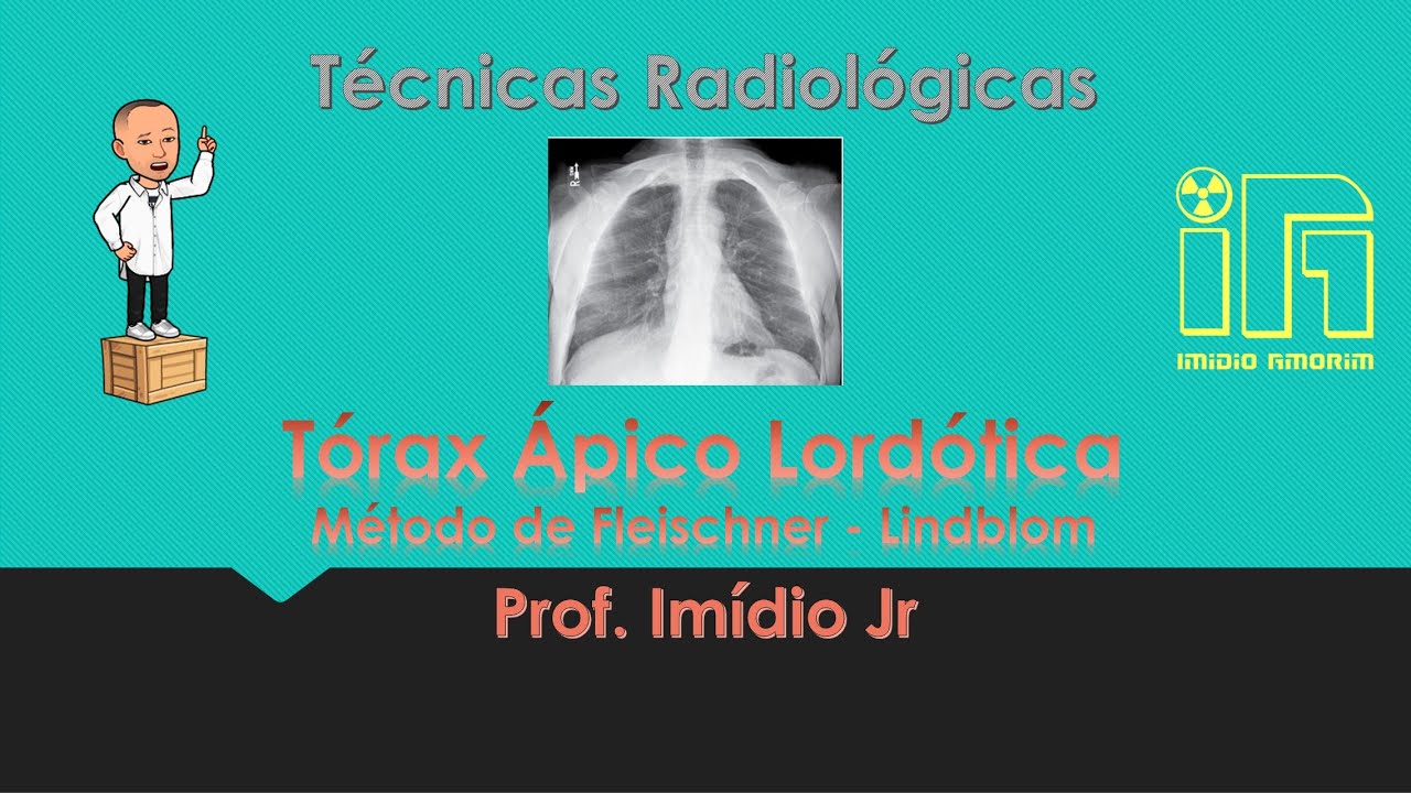 Radiografia do Tórax AP - Ápico Lordótico - método de Fleischner - YouTube