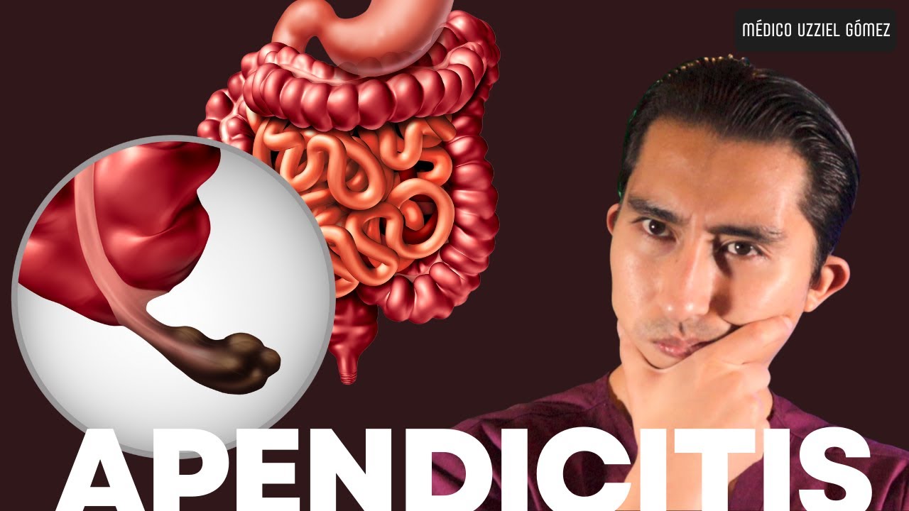 Como RECONOCER la APENDICITIS - YouTube