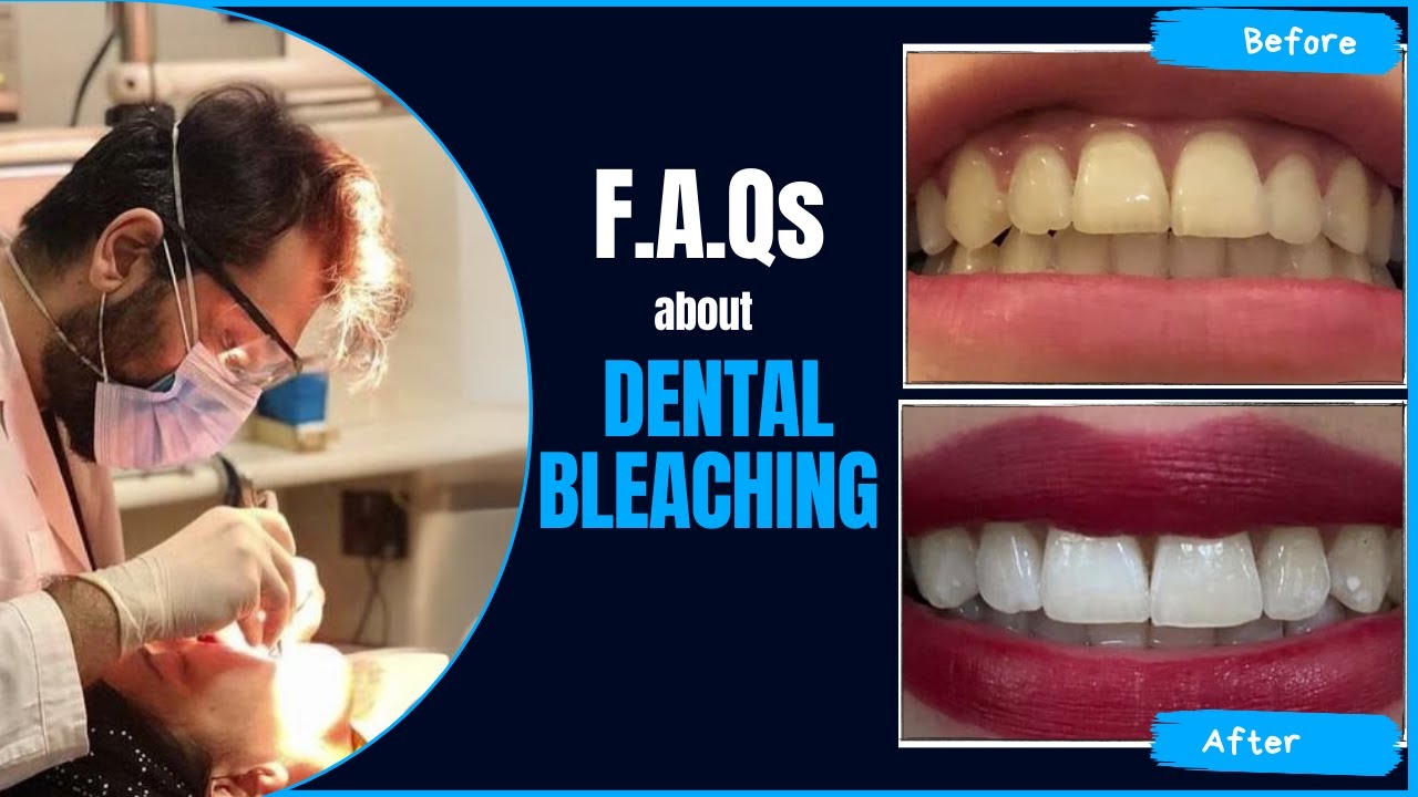 Best Way to Whiten Your Teeth Instantly | F.A.Qs about Dental Bleaching ...