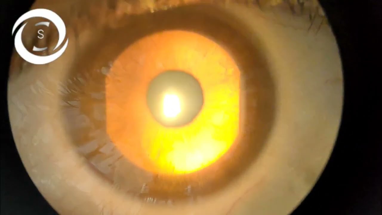 Hippus Pupil Reaction
