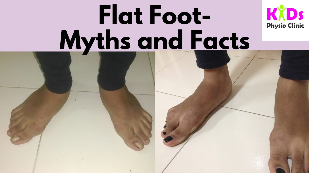 Flat Foot- Myths and Facts - YouTube