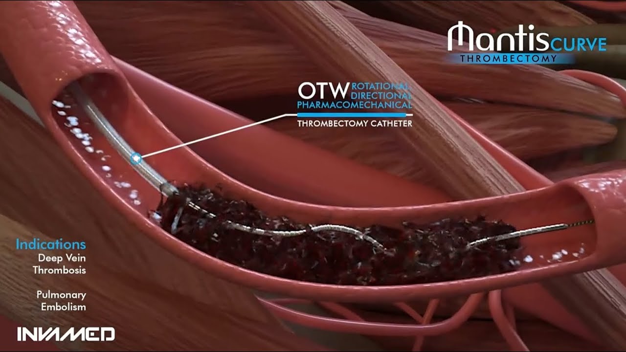 Mantis® CURVE OTW Thrombectomy System - YouTube