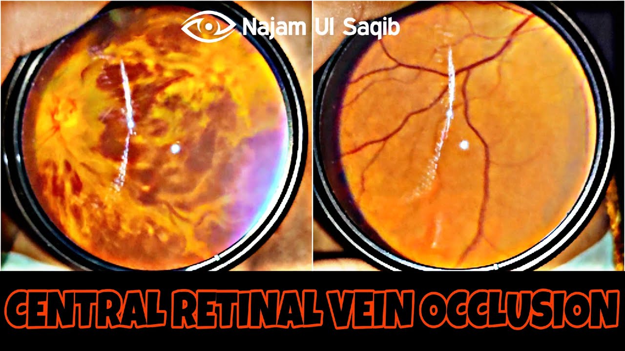 Central Retinal Vein Occlusion (CRVO). - YouTube