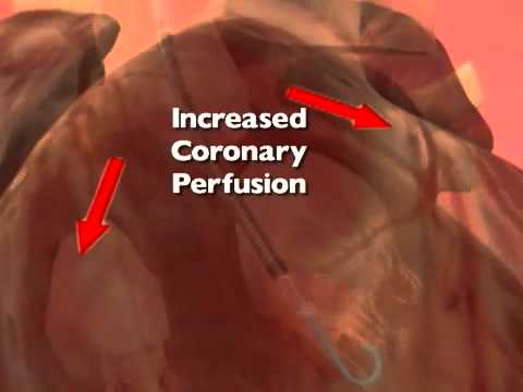 Impella 2 5 animation - YouTube