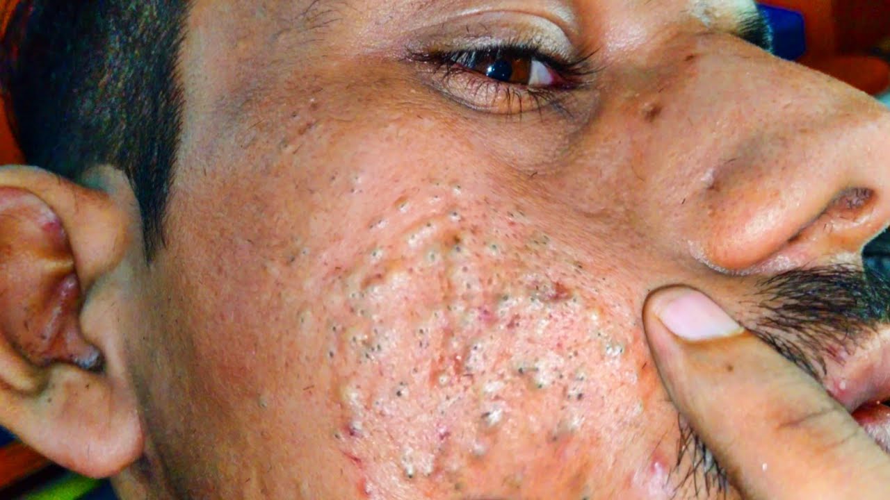 sac be spa blackheads elderly 2025 | sac be spa boy age blackheads 2025 ...