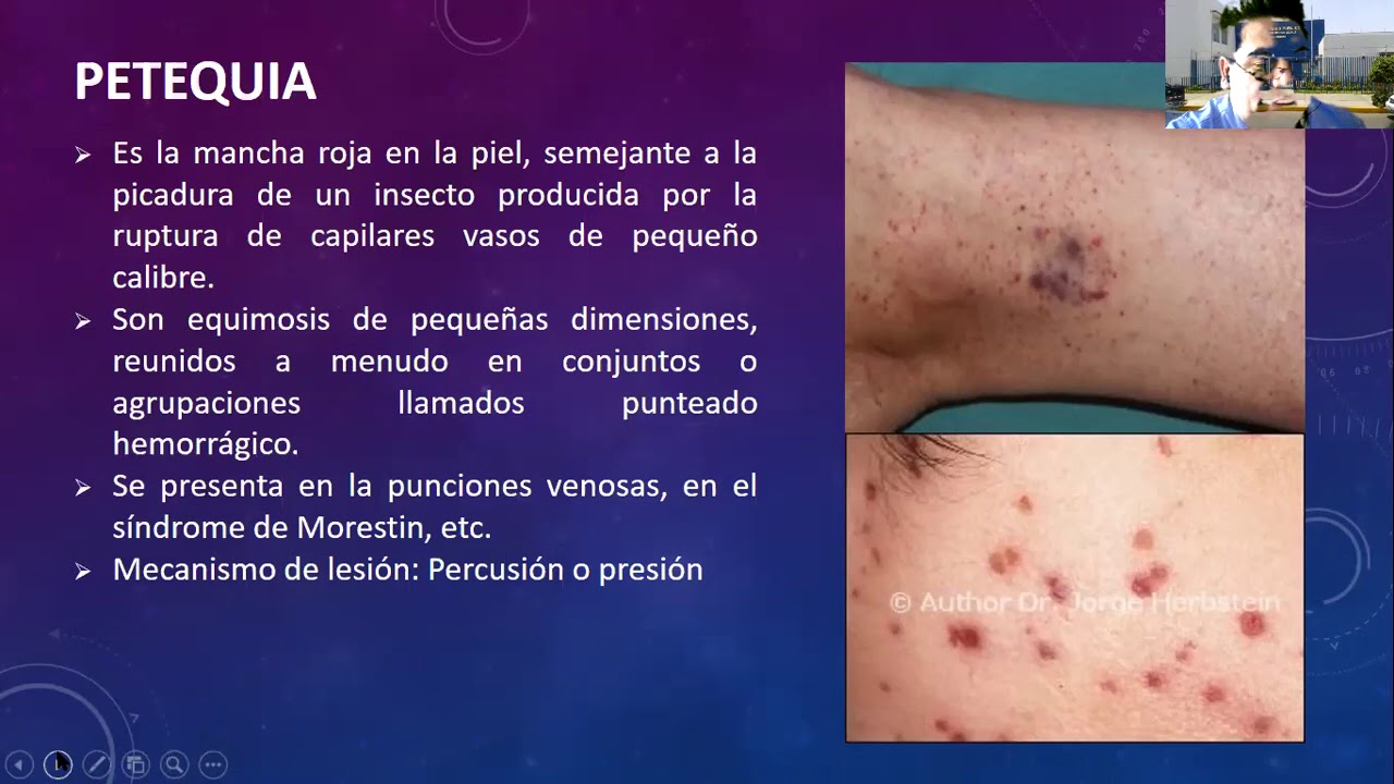 Lesiones Contusas - YouTube