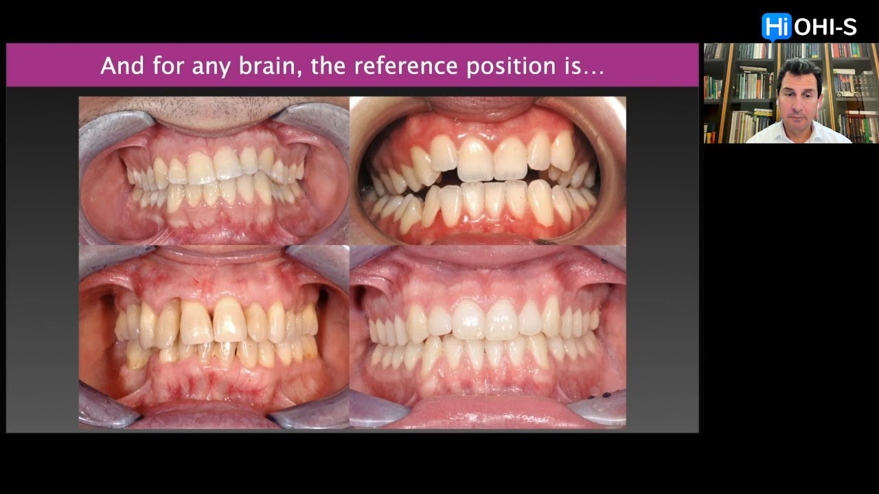 Gnathology and Occlusion: From Analysis of Occlusal Forces to ...
