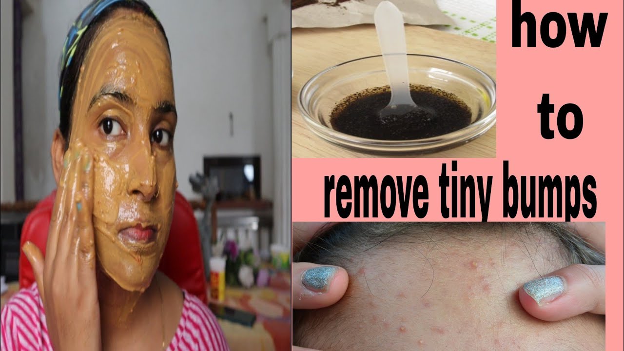 how to remove tiny bumps in 7 days ///// tiny bumps ko remove kre in ...