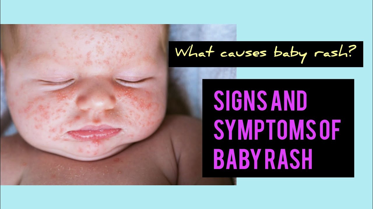 Baby Rash :Symptoms, Possible Causes, Prevention and Treatment . - YouTube