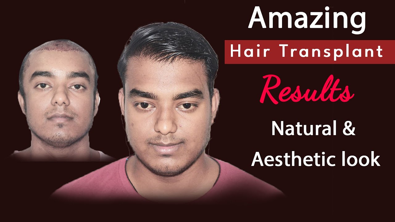 Hair Transplant Results In India Medispa India Dr Suneet Soni Youtube