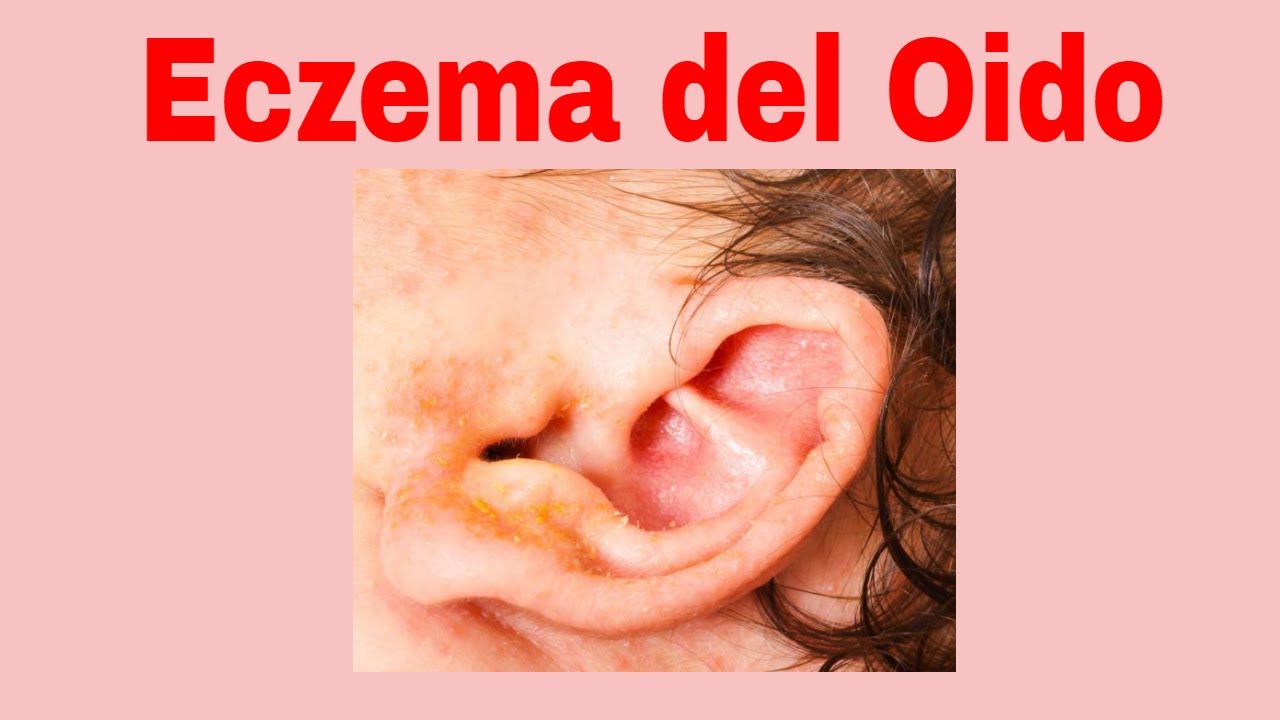 Eczema del Oido | Causas | Sintomas | Tratamiento - YouTube