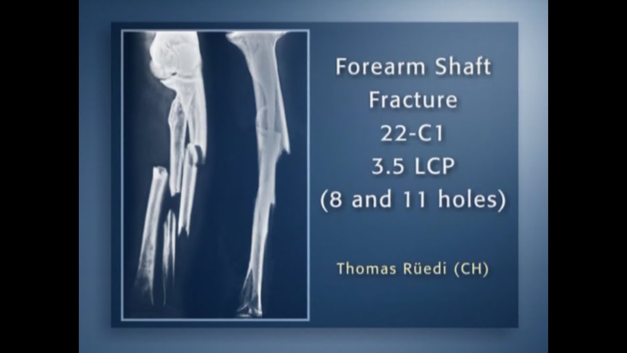 Forearm Shaft Fracture, AO Classification 22 C1 using 3.5 LCP 8 and 11 ...