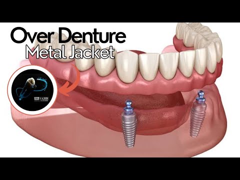 Dental Over Denture | Metal Jacket | #dental #health #dentalimplant ...