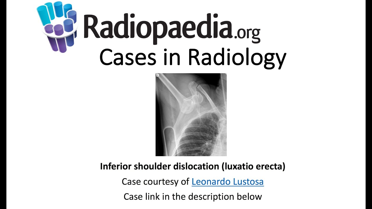 Inferior shoulder dislocation (luxatio erecta) (Radiopaedia.org) Cases ...